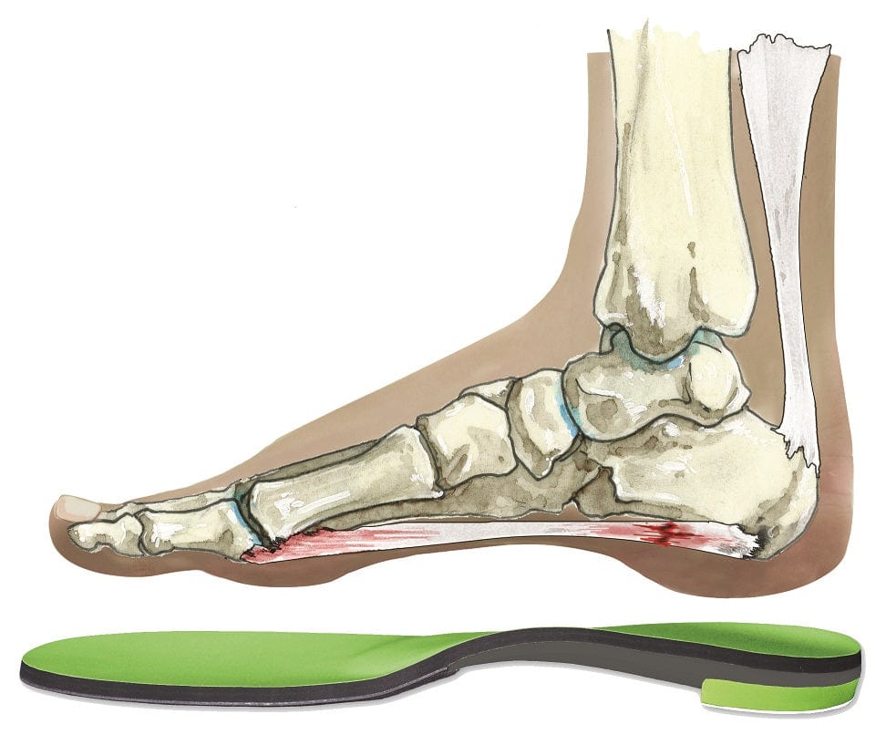 Biomechanical Engineering | Online Orthotics Design | Orthera - BIOM, LLC